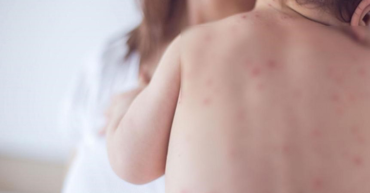 Улаанбурхан өвчний 55 тохиолдол бүртгэгдээд байна · Dorgio.mn