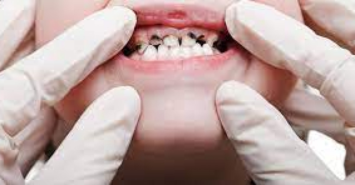 Нийслэлийн хэмжээнд үзлэгт хамрагдсан 40,280 хүүхдээс 95,33% нь шүдний өвчлөлтэй байна · Dorgio.mn